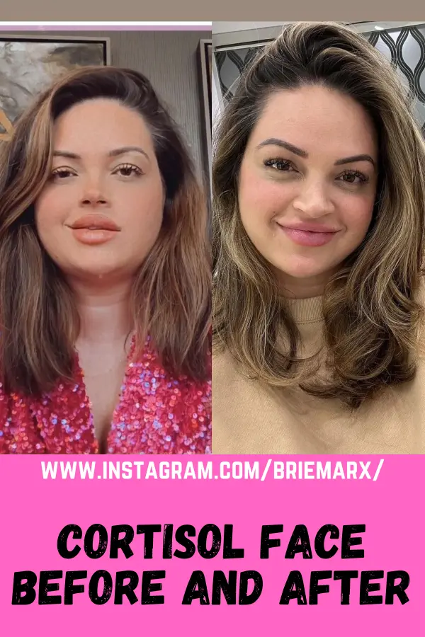 Do You Really Suffer From Cortisol Face?